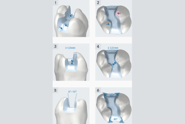 Inlays/Teilkronen | Komet Dental Shop