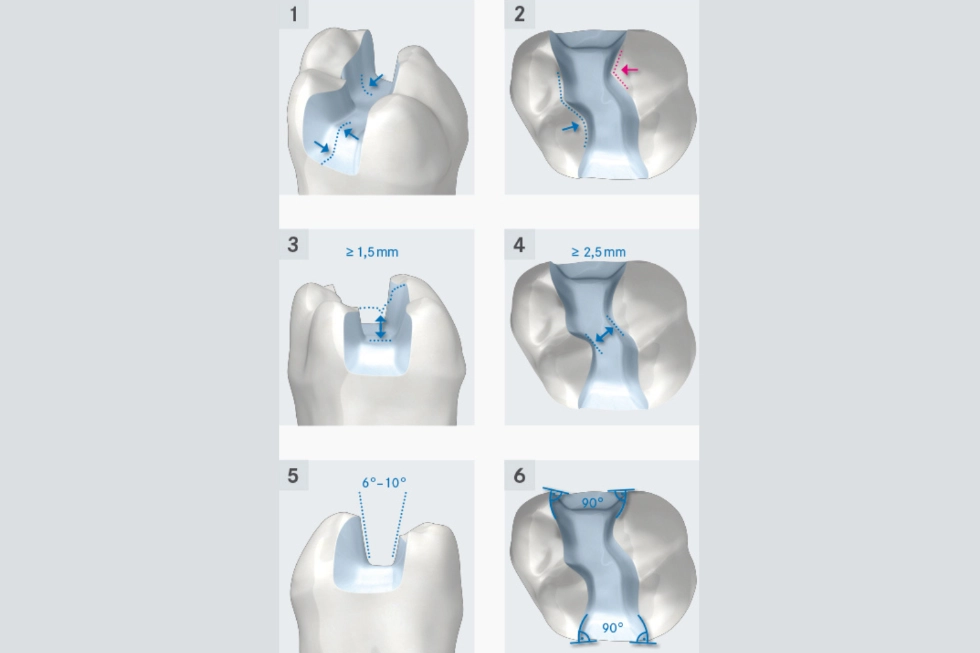 Inlays/Teilkronen | Komet Dental Shop