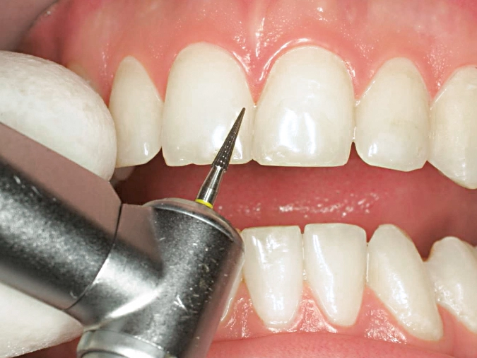 Finieren | Komet Dental Shop