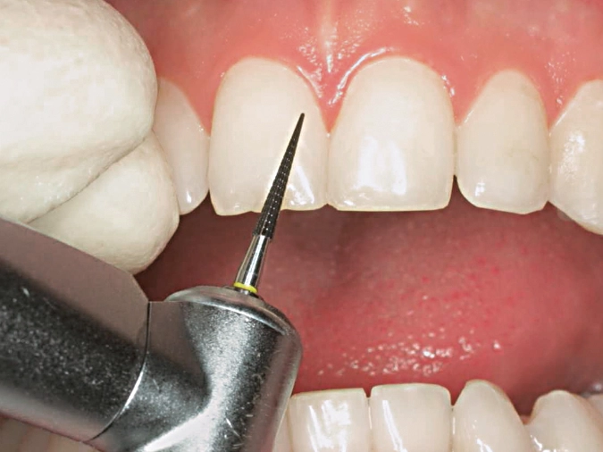 Finieren | Komet Dental Shop