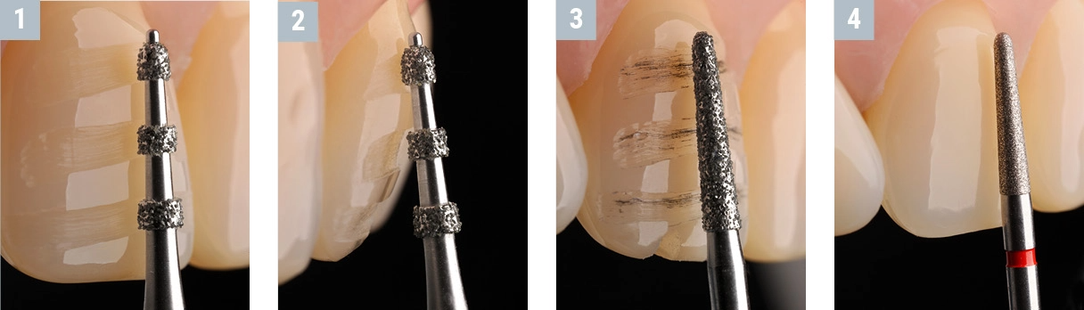 Veneers | Komet Dental Shop